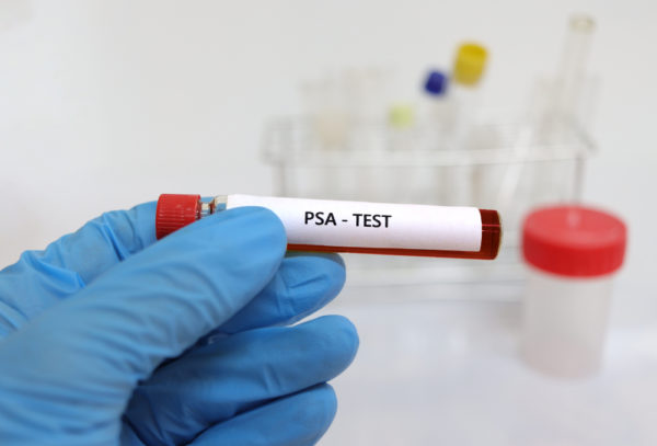 PSA v krvi: Správna hodnota a ako ho znížiť? | Uniprosta